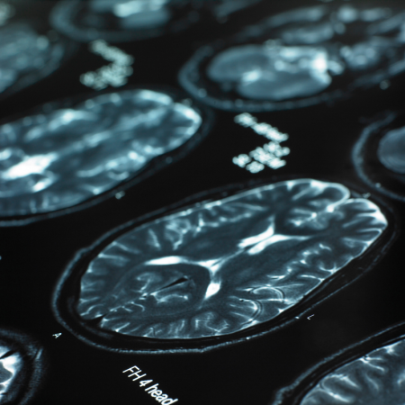 The Challenge of Diagnosing Catatonia in Autism and How Telemedicine ...